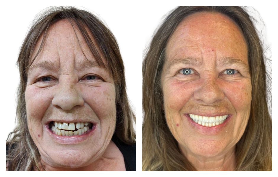 Snap-in Dentures vs. All-on-4® Implants
