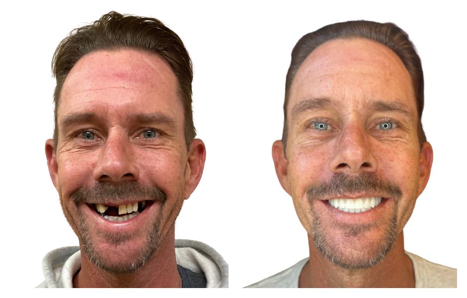 Permanent 24-Hour Teeth vs. All-on-4©© Temporary Prosthesis
