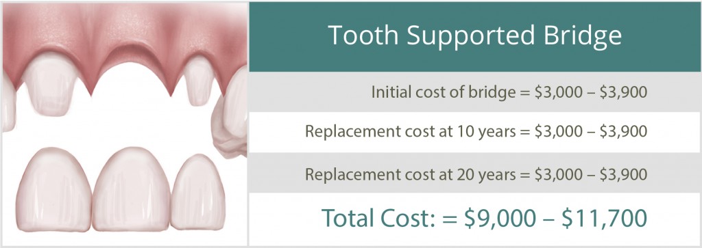 Cost of Dental Implant vs Cost of Bridge | Dr. Tsvetov