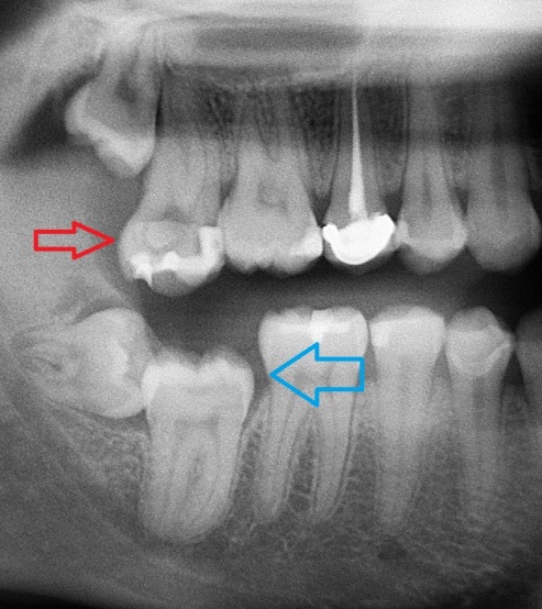 Three Common Problems Caused by Wisdom Teeth