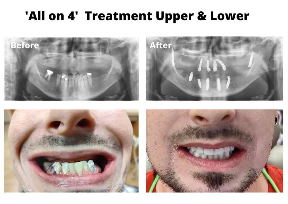 Zygomatic and Pterygoid Implants 🥇 Temecula Facial Oral Surgery