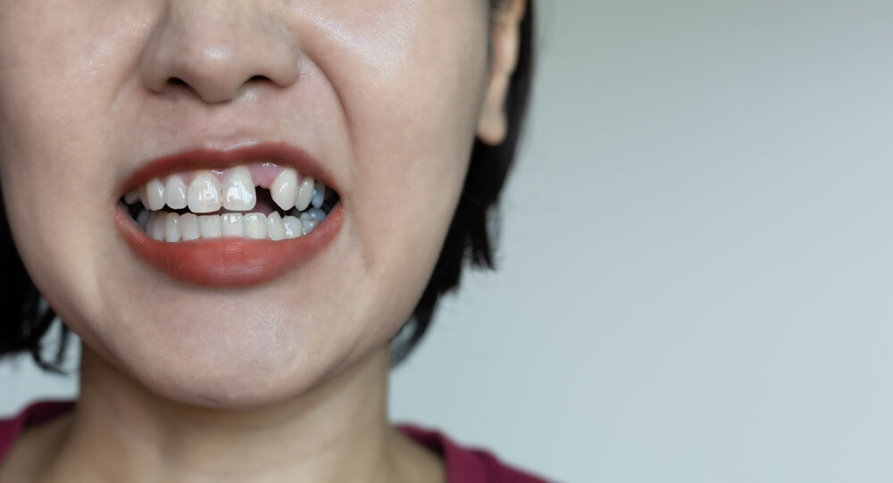 What to Know About Dental Implants After Tooth Extraction