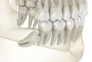 Preventing Emergency Extractions of Wisdom Teeth in Escondido