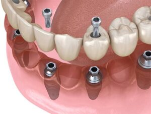 Reputable Oral Surgery & Dental Implant Center in Temecula